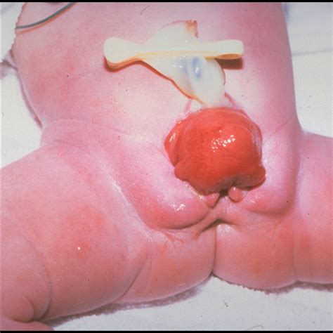 Bladder Exstrophy Pediatric Radiology Reference Article Pediatric