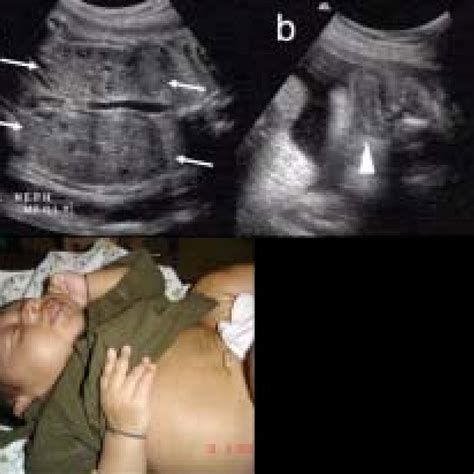 A D Klippel Trenaunay Weber Syndrome Subcutaneous Septate Cystic Download Scientific