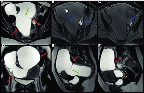 Axial Coronal And Sagittal T2w A D E F And Axial T1w Mr Images