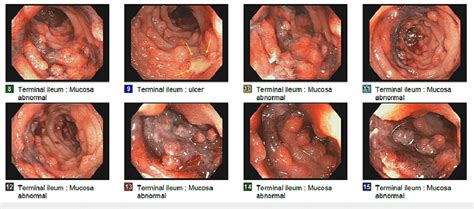 Colonoscopy Showing Features Of Terminal Ileitis Download Scientific