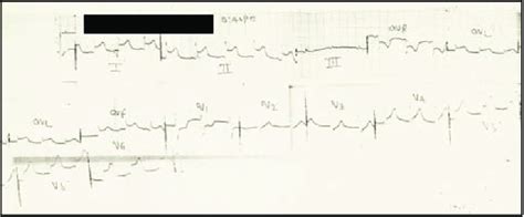 Ecg From Same Patient Showing Diffuse St Segment Elevation Download Scientific Diagram