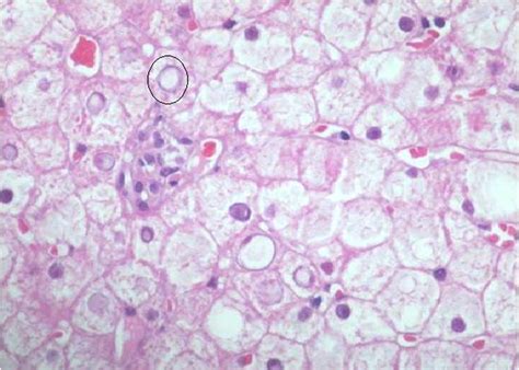 Glycogenated Hepatocytes Nuclei