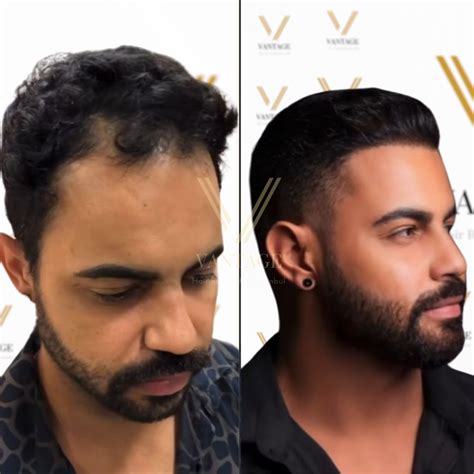 Dhi Hair Transplant In Turkey Costs In 2024 Vantage Clinic