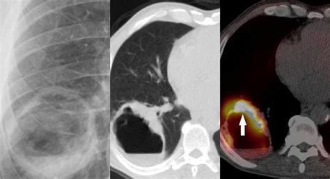 A Case Of Tuberculosis In The Cavitary Lesion Suggestive Of Neoplasm Sbmt