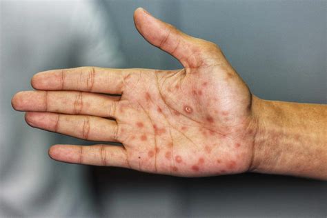 Doctors Begin Rationing Penicillin To Curb Deadly Syphilis Epidemic General Discussion Ar15com