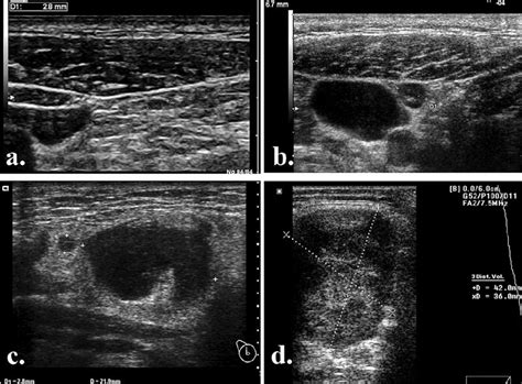 Irrelevance Of Lymph Node Size A Small 28mm Benign Node B Small