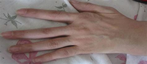 Arthritis In 2 Nd Metacarpal And 1 St And 5 Th Pip And Ulnar Deviation