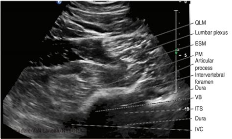 Quadratus Lumborum Ql3 Block Usg Guided Youtube
