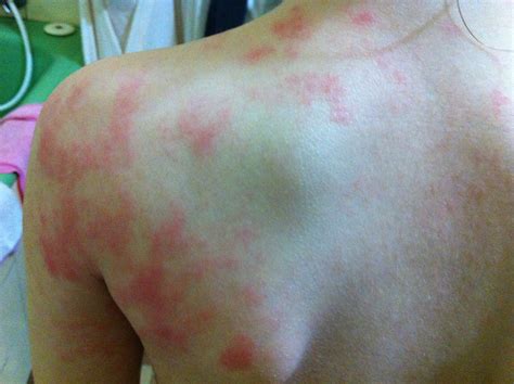 Acd A Z Of Skin Dermatitiseczema