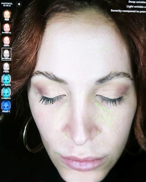 Skin Analyzer Cosmetic Derma Medicine