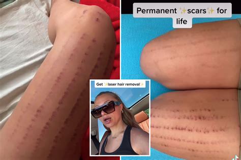 Laser Hair Removal Bad Experiences
