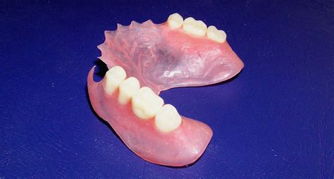 Unilateral Partial Denture Design At Eva Facy Blog