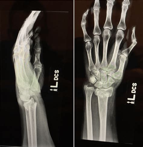 Fracture Wrist Distal Radius And Ulna Physeal Fractur