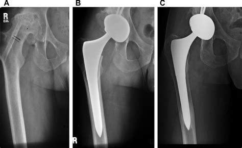 Minimum 10 Year Follow Up Of Cementless Total Hip Arthroplasty Using A Contemporary Triple