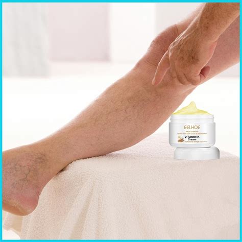 60g Varicose Veins Relief Cream Spider Veins Vasculitis Varicose Veins