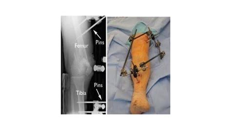 Distal Femur Fractures Classification With Treatment Pptx