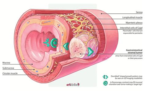Gastrointestinal Stromal Tumors And Their Appearance In Patients With