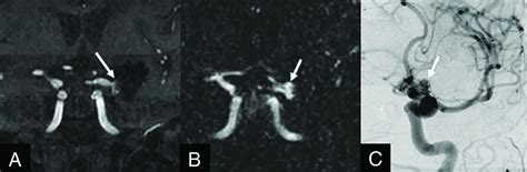 Differential Subsampling With Cartesian Orderingmra For Classifying Residual Treated Aneurysms