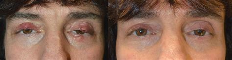 Stye Symptoms Treatment And Prevention Stye Nhs