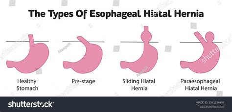 Hourglass Stomach Sliding Hernia