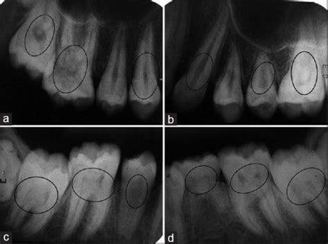 Dentin Dysplasia