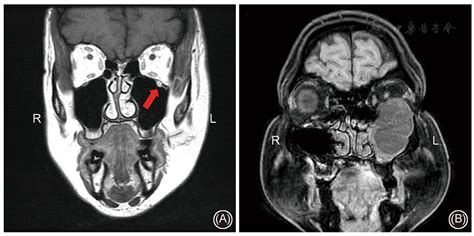Infraorbital Nerve Mri
