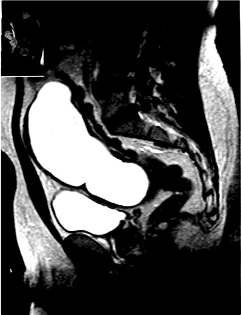 An Unusual Pelvic Mass Pmc