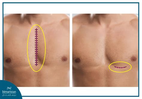 Midcab Minimally Invasive Direct Coronary Artery Bypass