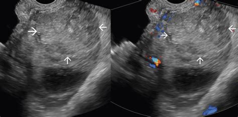Ultrasound Evaluation Of The Ovaries Radiology Key