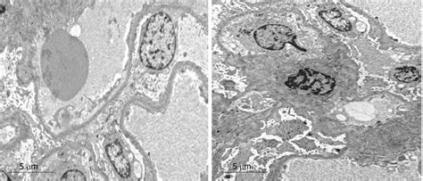 Electron Microscopy Extensive Effacement Of Podocyte Foot Processes