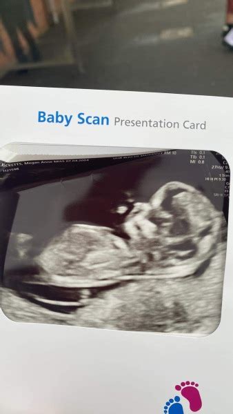 Abnormal Scan Mumsnet