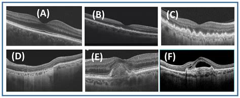 Wet Amd Oct Ai Supported Test Predicts Eye Disease Three Years Before