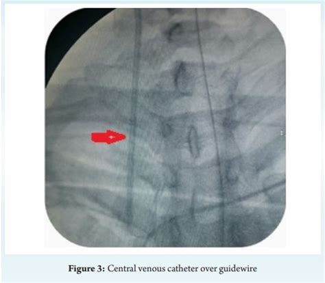 An Alternate Technique For Insertion Of Central Venous Catheter In