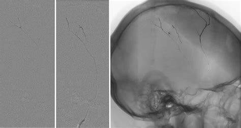 Subdural Hematoma Preventing Recurrence With A Three Step Onyx Embolization