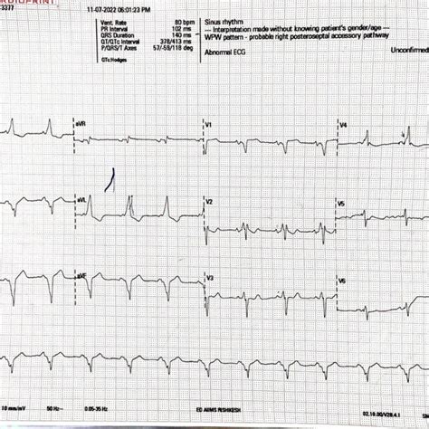 Ecg Showing Atrial Flutter With 21 Atrioventricular Conduction The
