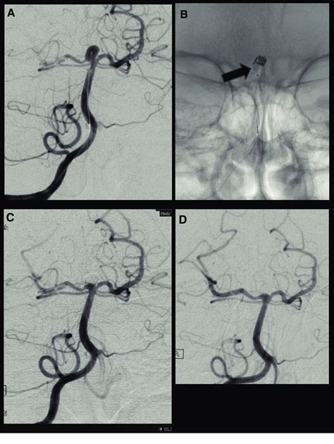 Antero Posterior View Of The Right Vertebral Artery Angiogram In Case Download Scientific