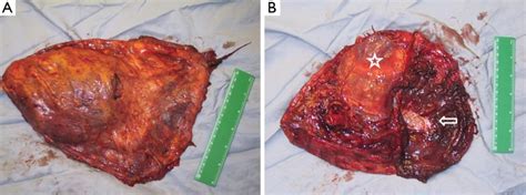 Extrapleural Pneumonectomy Epp Vs Pleurectomy Decortication Pd Pmc