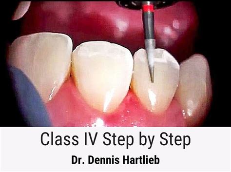 Composite Restoration Class Iv Step By Step Dr Dennis Hartlieb