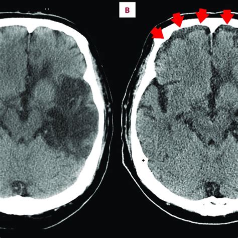 Computed Tomography CT Imaging Of The Head A Head Computed Download Scientific Diagram