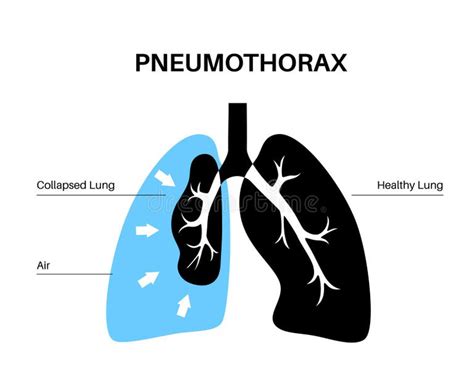 Pneumothorax Anatomical Poster Stock Vector Illustration Of Chest