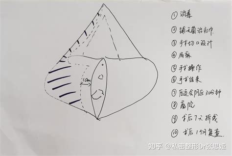 详细介绍私密小阴唇手术的全过程 知乎