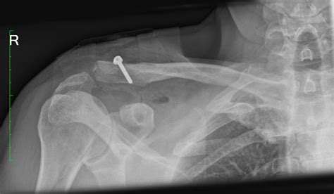 Ac Joint Injuries Neill Thompson