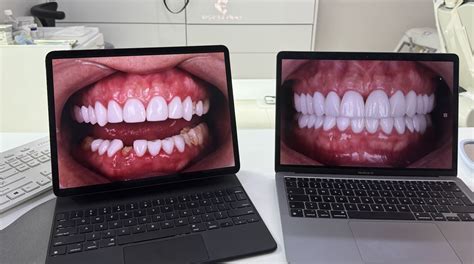 Авторские высокохудожественные виниры — это как? – IMPLANTUM