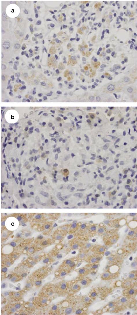 Immunohistochemistry Of Tlrs In Pbc Diseased Liver A C