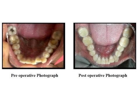 Importance Of Crown On Root Canal Treated Tooth