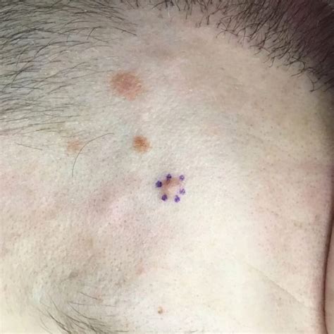 Intradermal Nevus Causes Diagnosis And Safe Removal