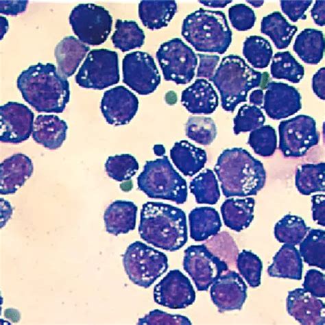 Ascitic Fluid Examination For Malignant Cells Test In Delhi Ncr India