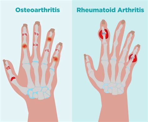 Differences Between Rheumatoid Arthritis Vs Osteoarthritis
