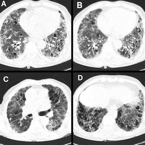 Hrct Scan Of The Thorax A And C Tractional Bronchiectasis And