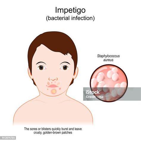 농가진 피부 감염이있는 얼굴 아기 고름딱지증에 대한 스톡 벡터 아트 및 기타 이미지 고름딱지증 연조직염 포도상구균